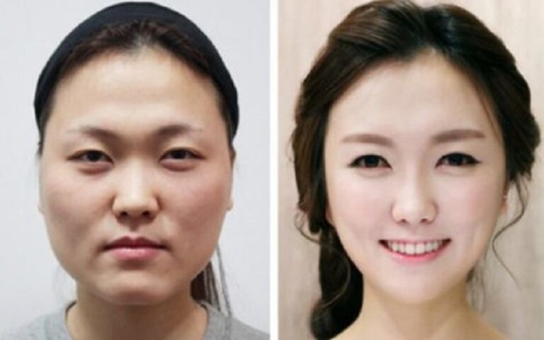 How to Prepare for a Jaw Reduction Procedure: Tips and Tricks for a ...
